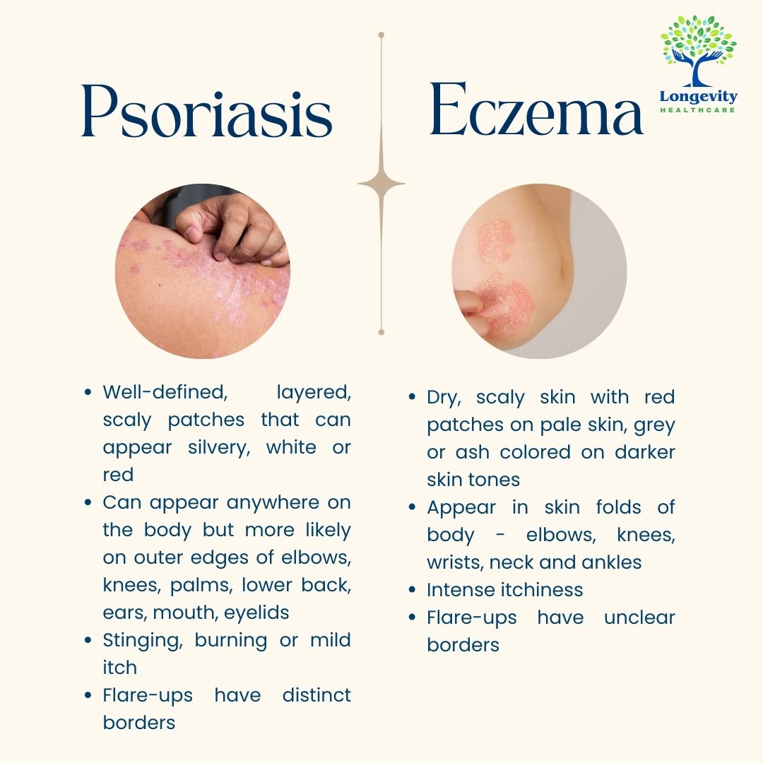 Longevity Psoriasis Vs Eczema Whats The Difference These Two