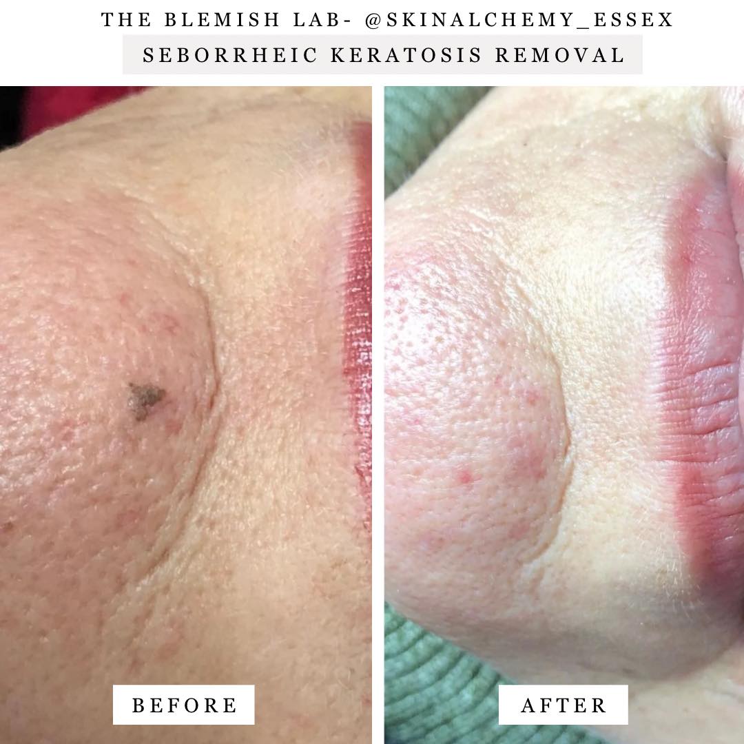 Skin Seborrheic Keratosis Removal Before And After Seborrheic 2354
